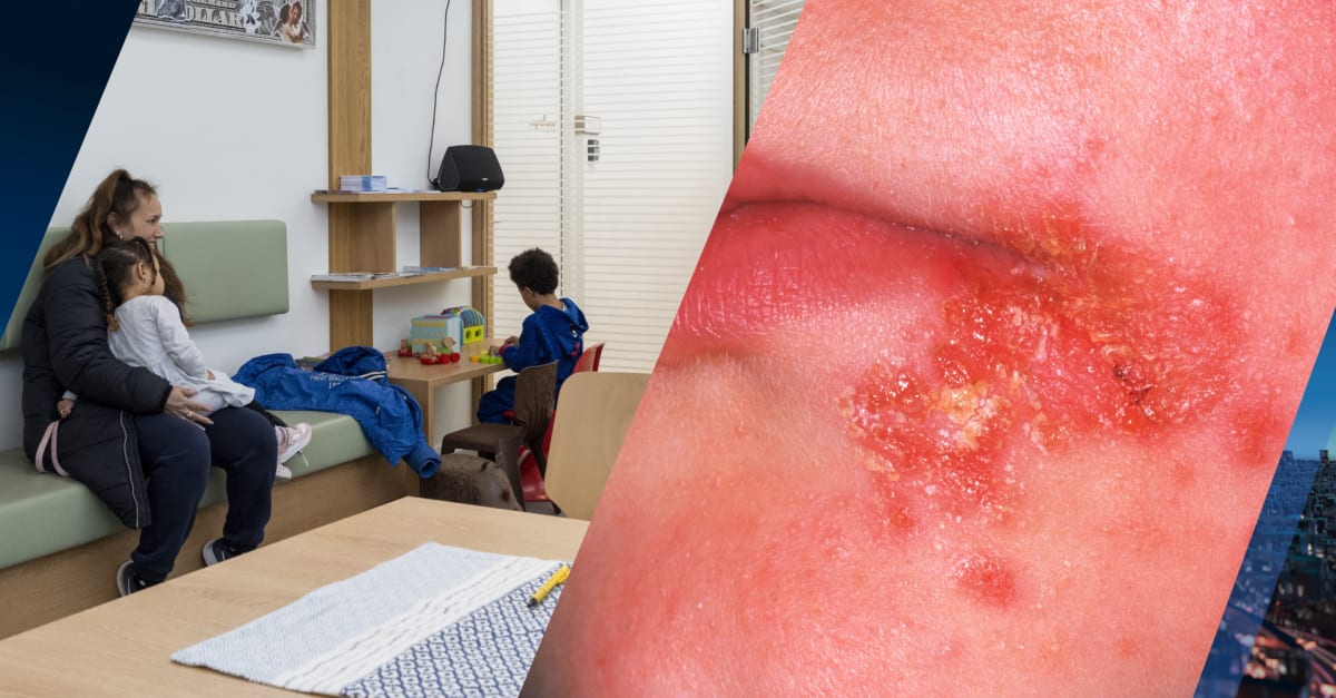 Veel kinderen hebben last van krentenbaard: zo voorkom je het | Hart ...